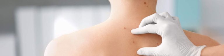 Skin Tags /Nevus Removal » 4D London Clinic